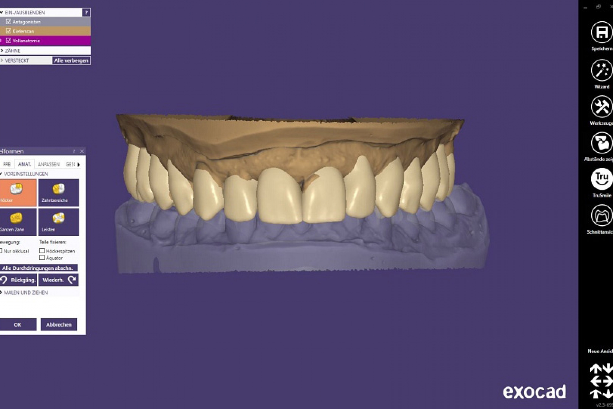 Tooth Library ZRS Wiedmann - Exsotec®