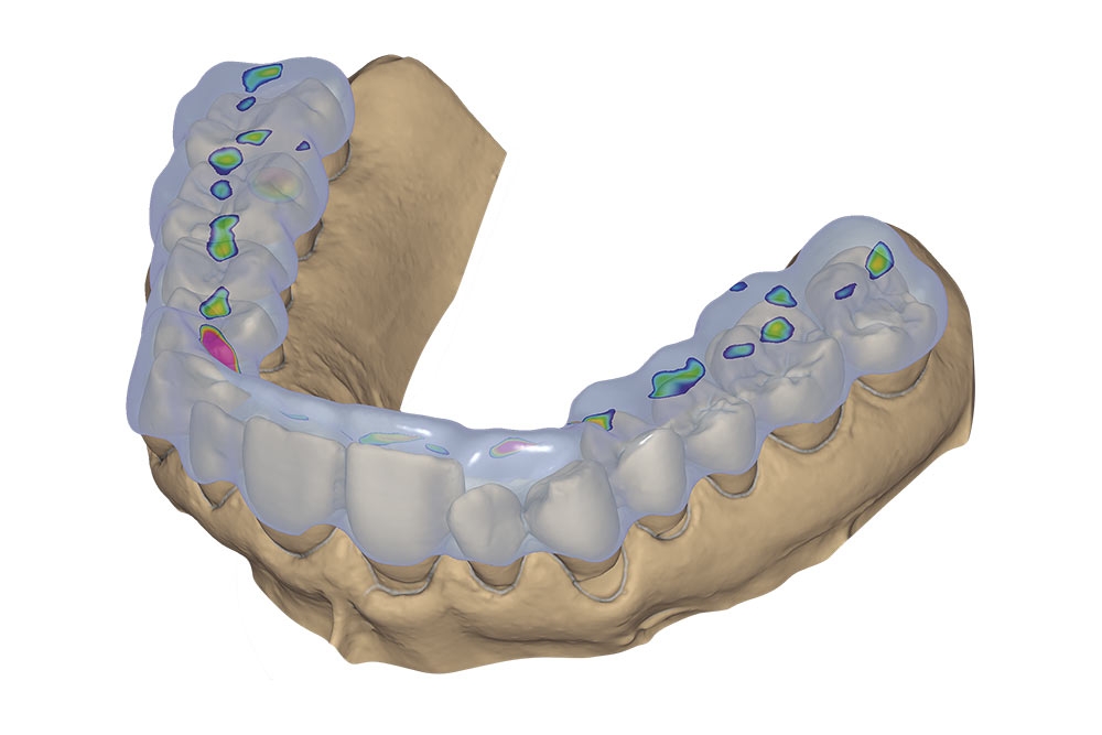 Bite Splint Module - Exsotec®